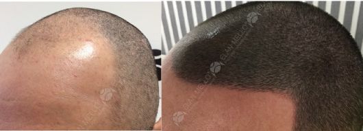 Guia da Micropigmentação Capilar – As 11 Dúvidas Mais Frequentes!